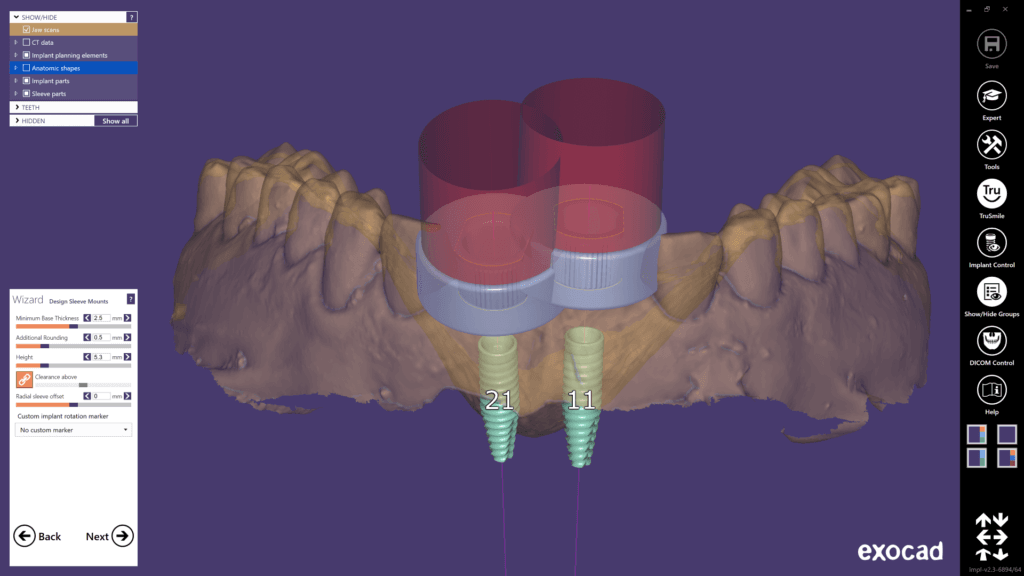 Exoplan d'Exocad – Planification implants & guides chirurgicaux